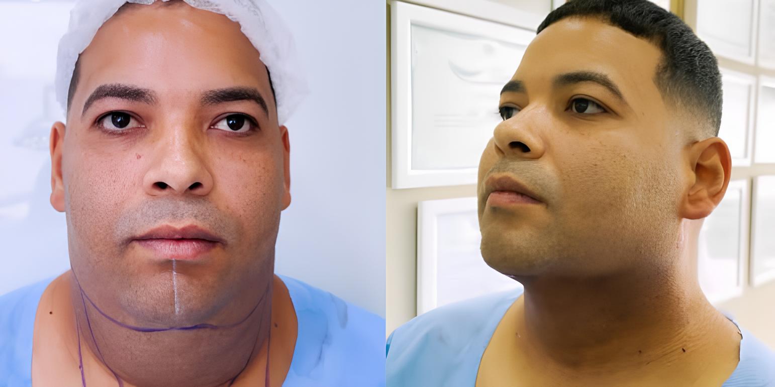 Impressionante! Cirurgião viraliza ao mostrar resultado de lipo de ...
